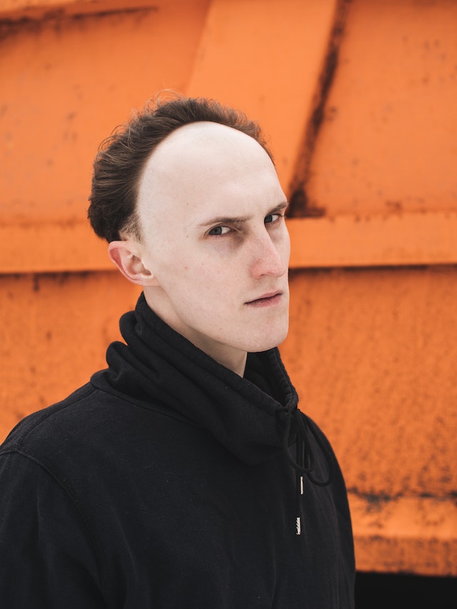 Receding Hairline: Causes, Treatments, and Prevention Strategies ...
